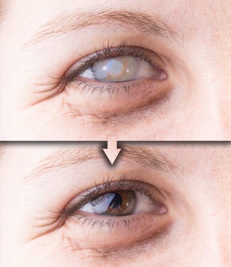 Is Blindness Due to Cataracts Possible? | ADV Vision